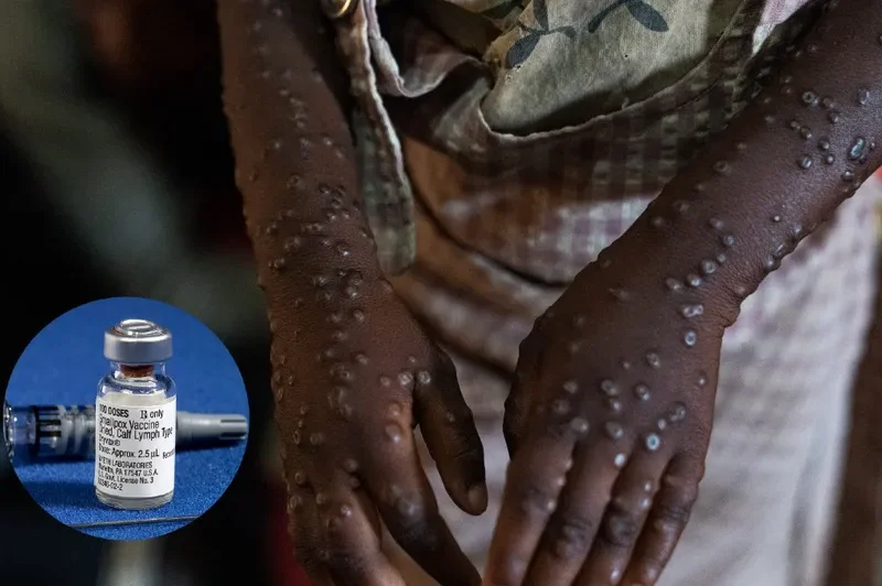 APRUEBA COFEPRIS VACUNA CONTRA VIRUELA DEL MONO — Renueva TV